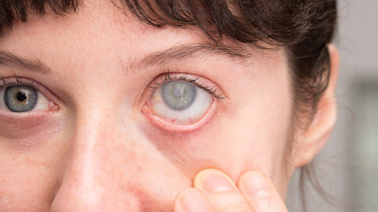 10 Hereditary Eye Diseases and How to Prevent Them